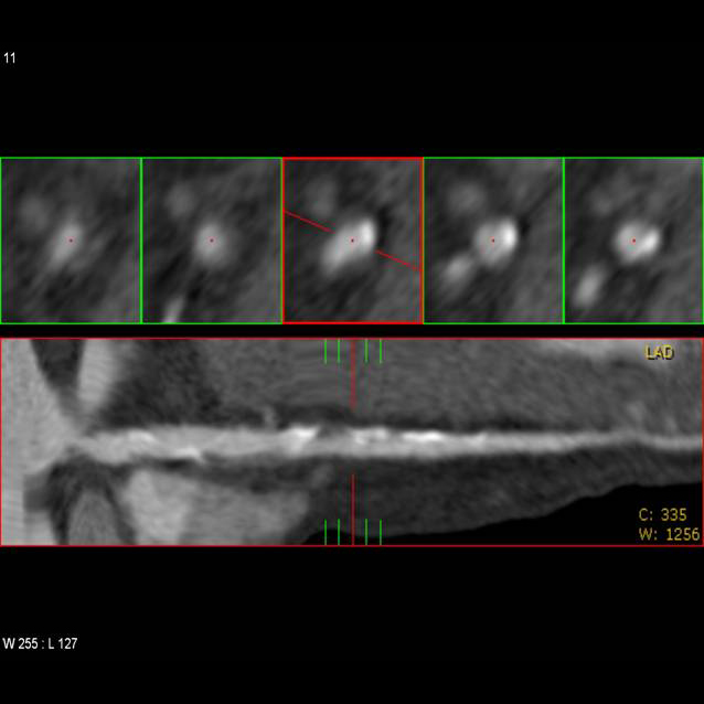 La tomodensitométrie cardiaque - 15