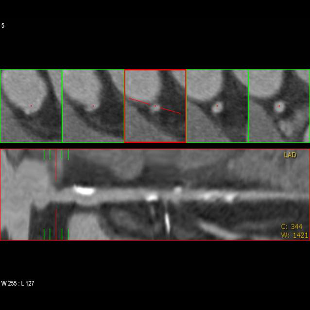 La tomodensitométrie cardiaque - 15