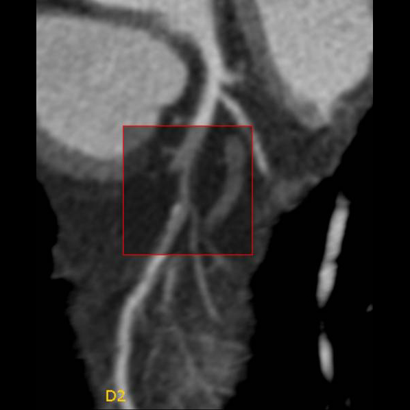 La tomodensitométrie cardiaque - 15