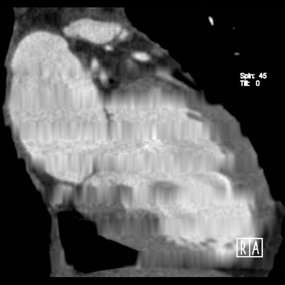 La tomodensitomÃ©trie cardiaque - 5